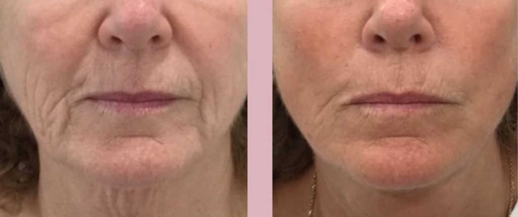 Alma Opus - Plasma RF | Park Ridge Medical Centre