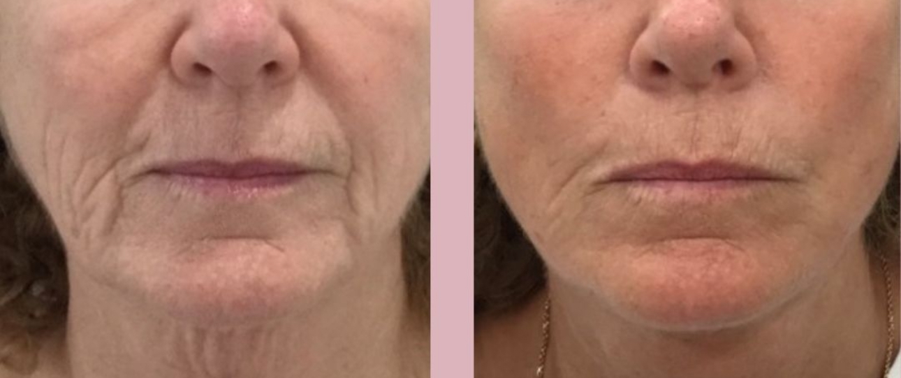 Alma Opus - Plasma RF | Park Ridge Medical Centre