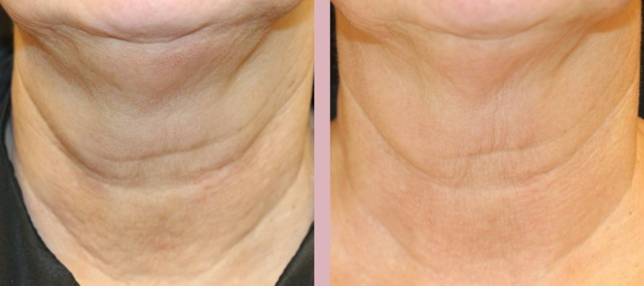 Alma Opus - Plasma RF | Park Ridge Medical Centre