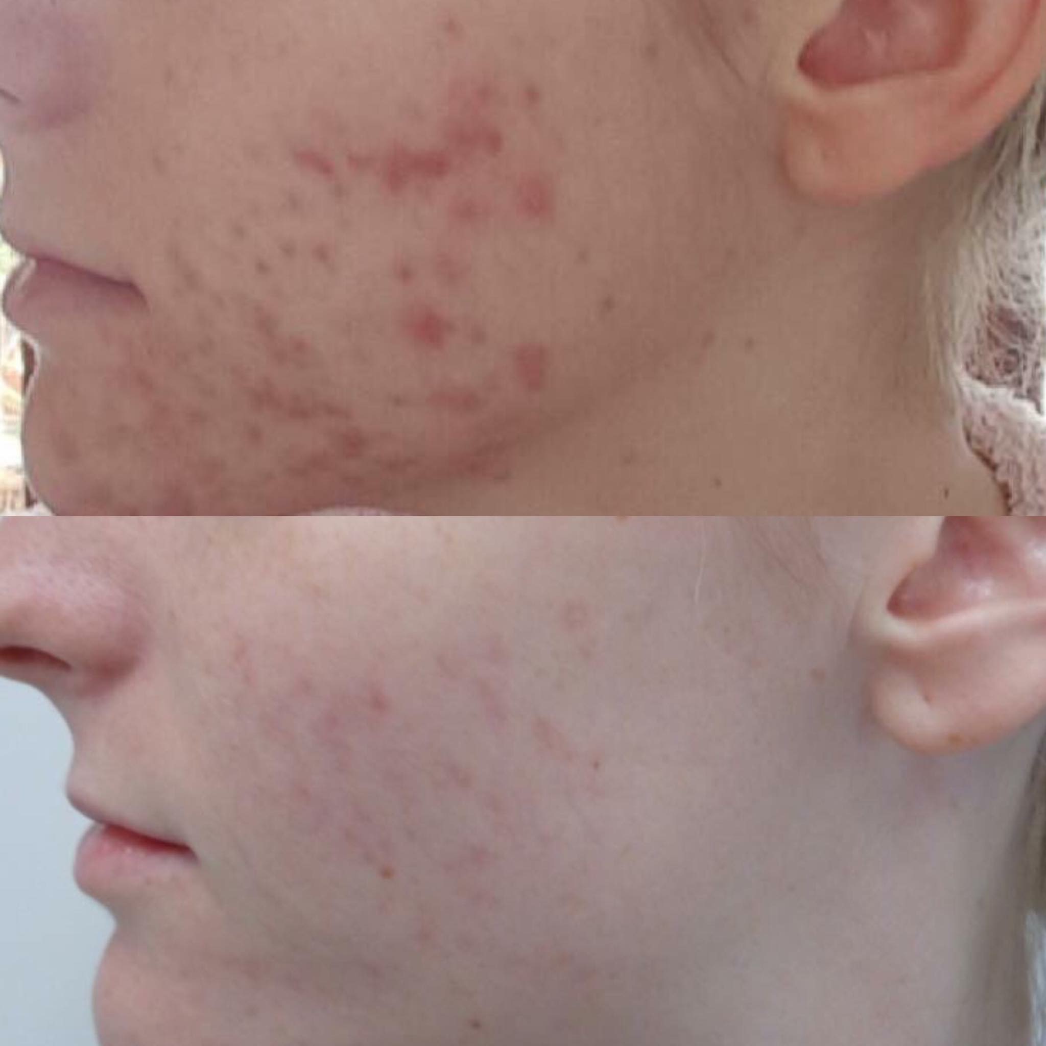 Acne & Scar Treatment Park Ridge | Park Ridge Medical Centre