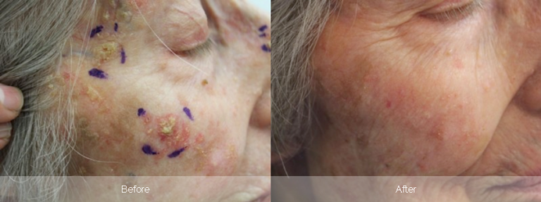 LED & PDT Light Therapy | Park Ridge Medical Centre